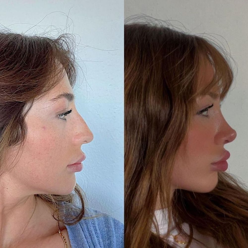 Rhinoplasty in Turkey • Dr. Selim Turan